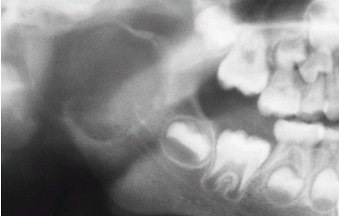 Aneurysmal Bone Cyst. - MEDizzy