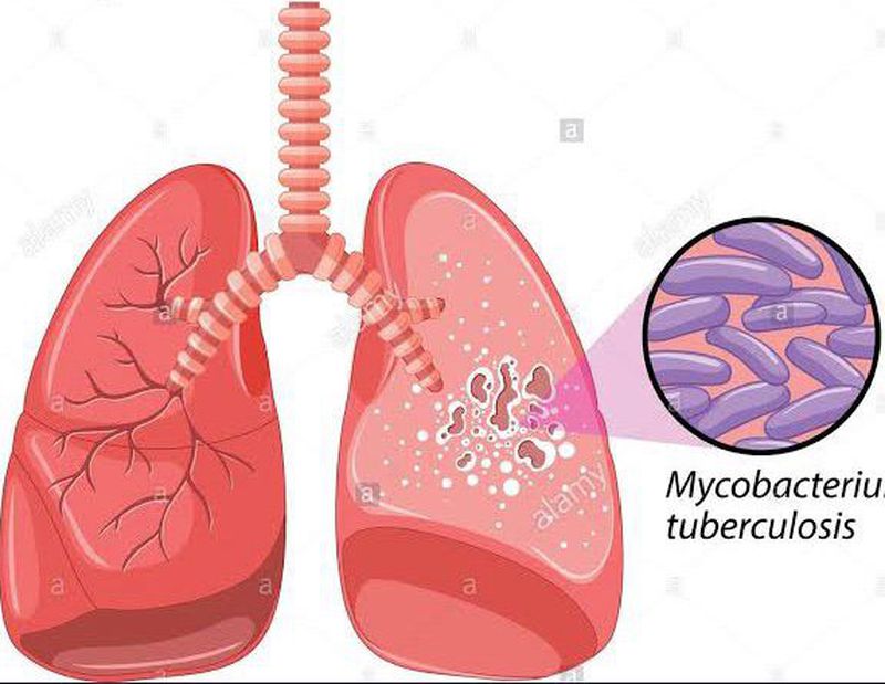 Tuberculosis - MEDizzy