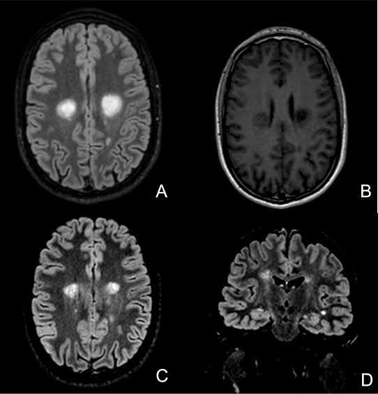 Symptoms Of Schilder s Sclerosis MEDizzy