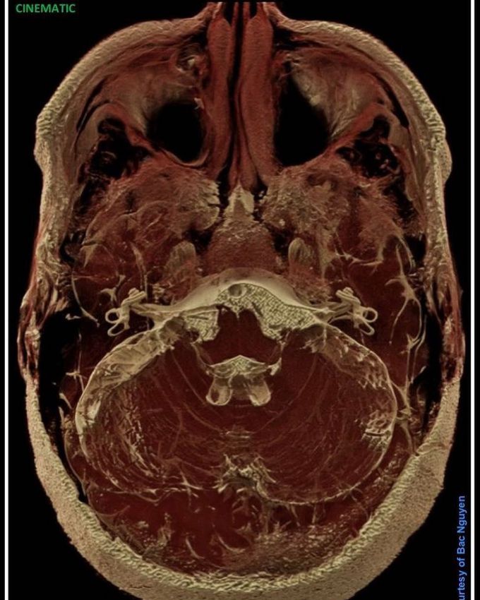 Internal Acoustic Canal (IAC) - MEDizzy