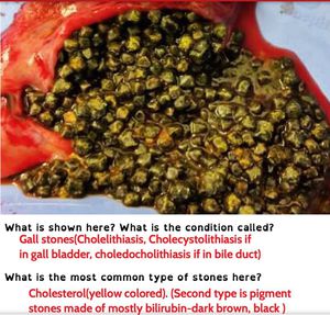 Gallstones Aka cholelithiasis - MEDizzy