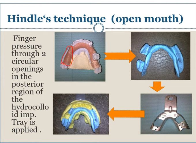 Hindle's Technique - MEDizzy