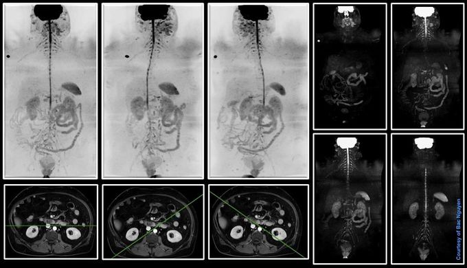 Whole Body DWI performed direct coronal. Achieving both - MEDizzy