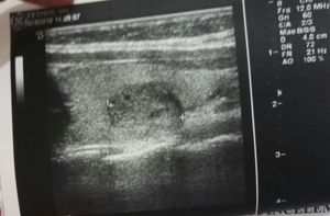 What do you think about my thyroid nodule? - MEDizzy