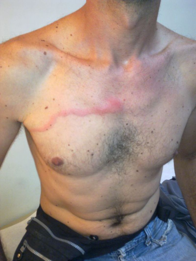 Mondors Disease Penile Mondor's Disease: Symptoms, Causes, And