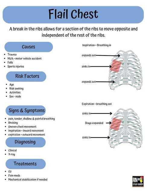 Flail Chest Treatment