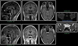 MR Pituitary Gland – ZOOMit Single Shot Echo Planar Imaging - MEDizzy