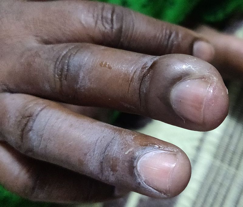 Finger swelling - MEDizzy
