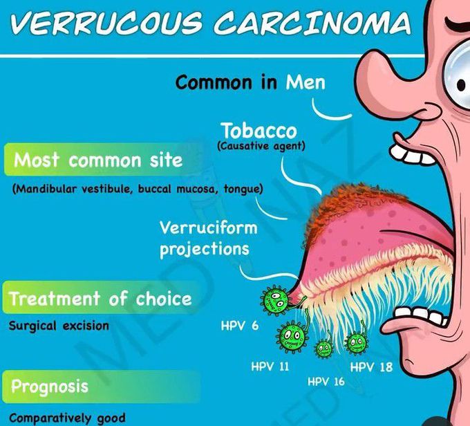 Verrucous carcinoma - MEDizzy
