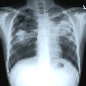 Active pulmonary TB - MEDizzy