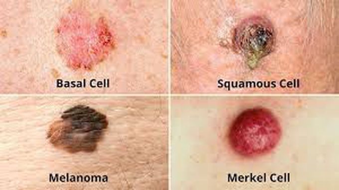 Squamous and basal cell carcinoma - MEDizzy