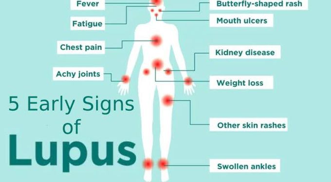 Early signs of lupus - MEDizzy