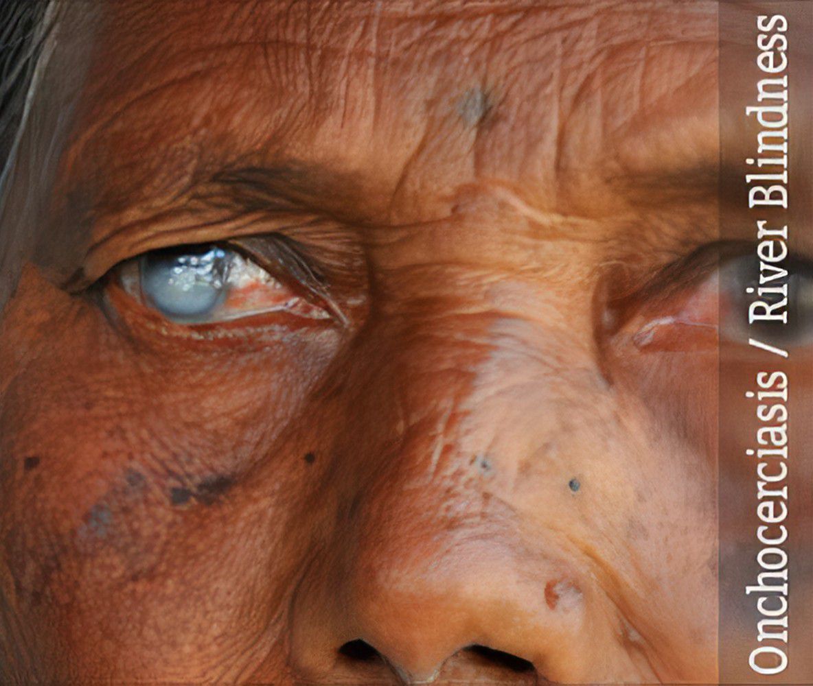 Onchocerciasis MEDizzy
