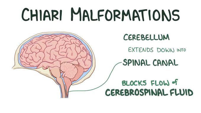 Arnold-Chiari malformation - MEDizzy