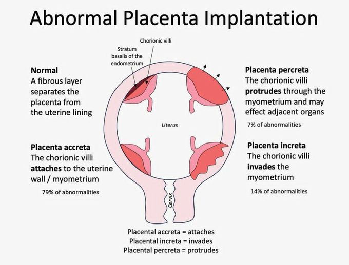 Abnormal Placenta Implantation - MEDizzy