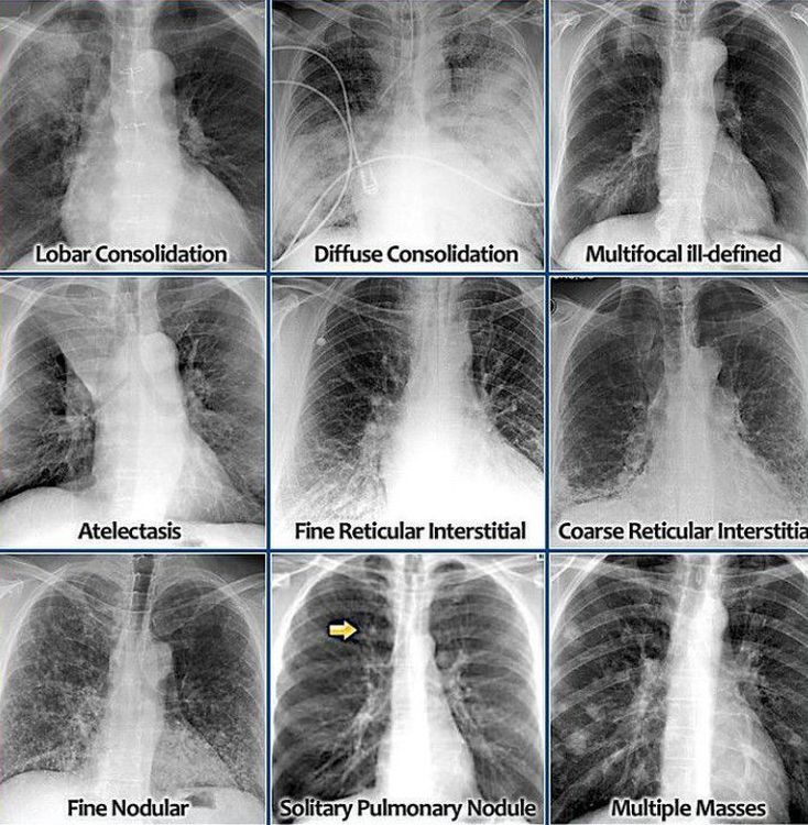 CHEST X RAY INTERPRETATION MEDizzy