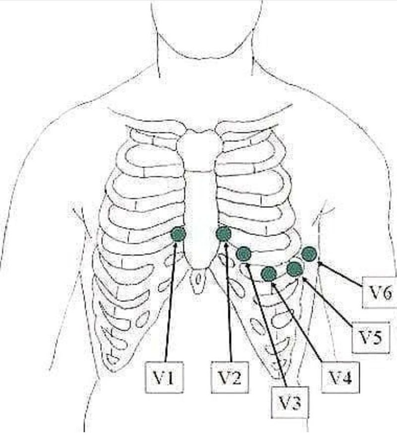 Pediatric Ecg Electrode Placement