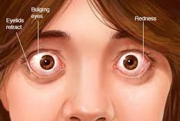 Graves disease - MEDizzy
