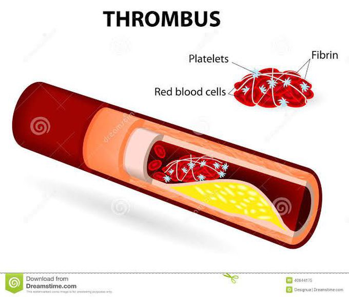 Thrombus - MEDizzy