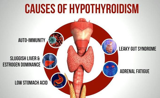 causes of hypothyroidism - MEDizzy