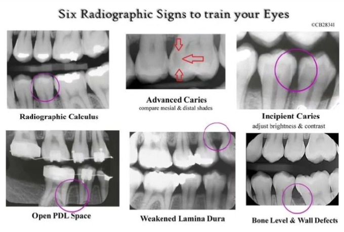 Periapical Radiographs - MEDizzy