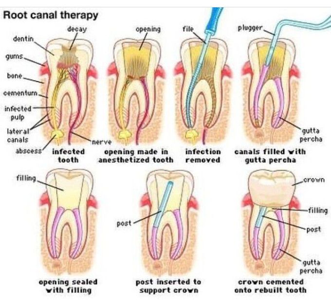 Root Canal Therapy - MEDizzy