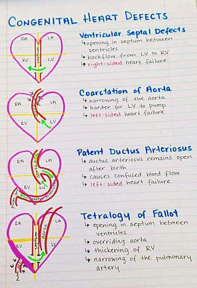 Congenital heart defects - MEDizzy