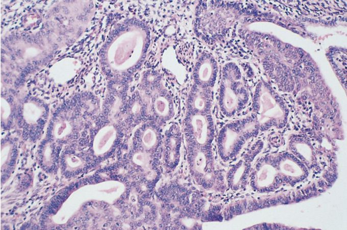 Endometrial disorder - MEDizzy