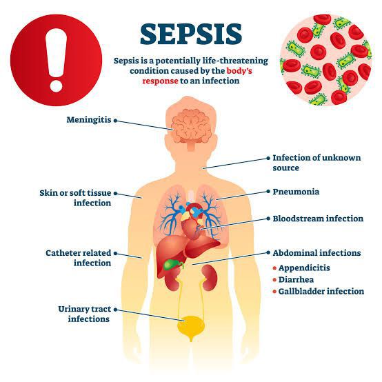 Sepsis - MEDizzy
