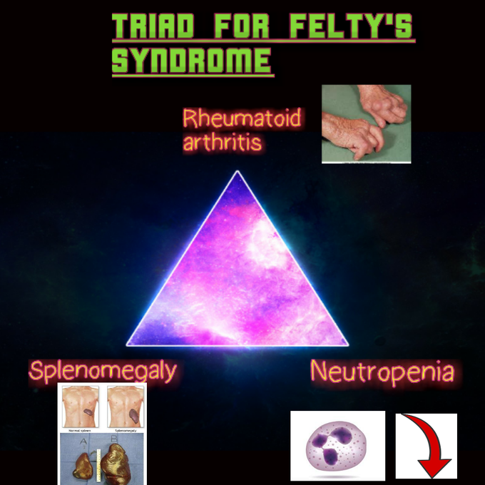 FELTY'S SYNDROME - MEDizzy