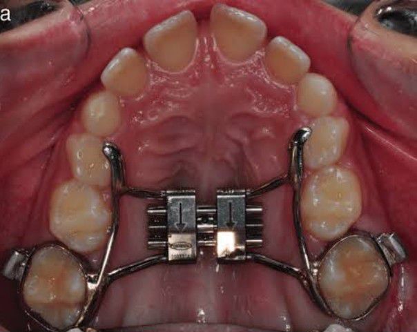 Hyrax expander - MEDizzy
