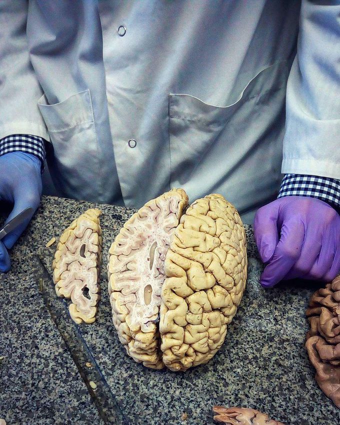 Beautiful brain - MEDizzy