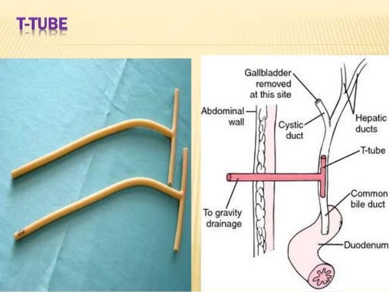 T Tube Drain Removal