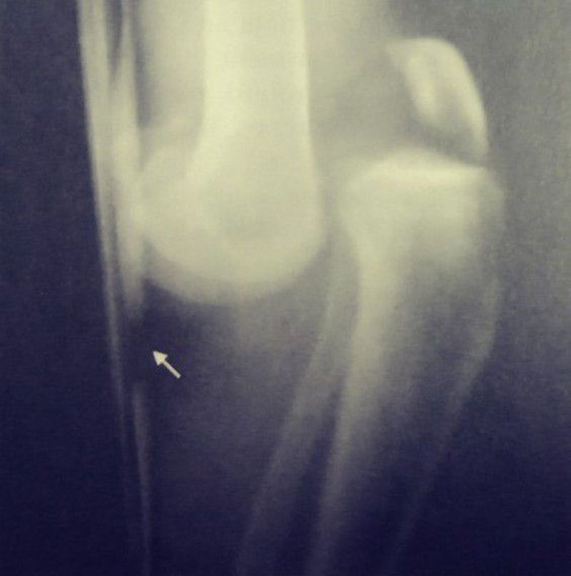 Radiograph showing the posterior dislocation of knee joint - MEDizzy