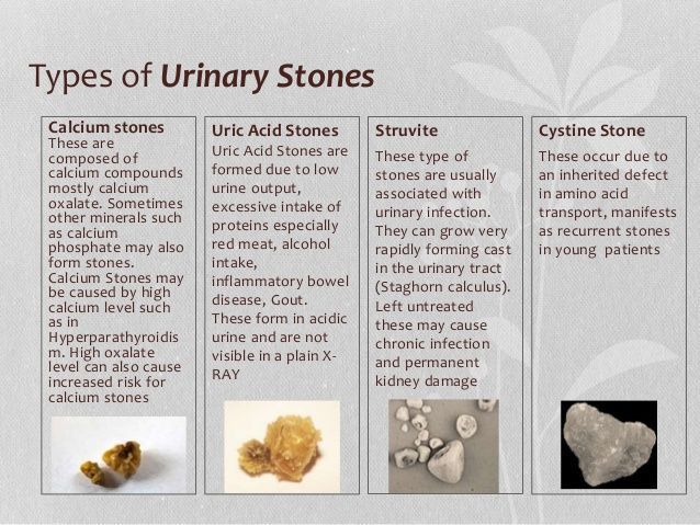 Types Of Kidney Stones Chart