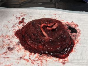 Placenta afterbirth - MEDizzy