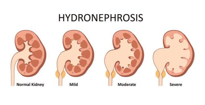 Hydronephrosis - MEDizzy