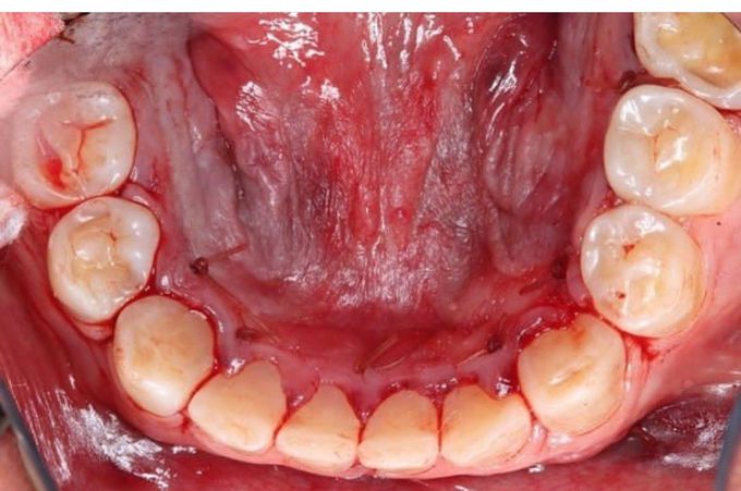 Mandibular Tori -PostOp - MEDizzy