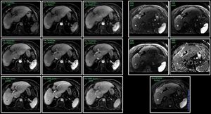 MRI Liver Imaging with a 70cm bore @ Siemens 3T - MEDizzy