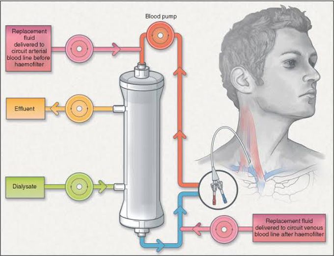 Renal replacement therapy - MEDizzy