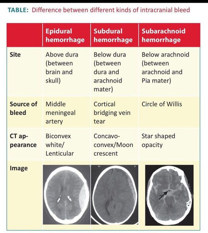 Different kinds of Intracranial bleeding - MEDizzy