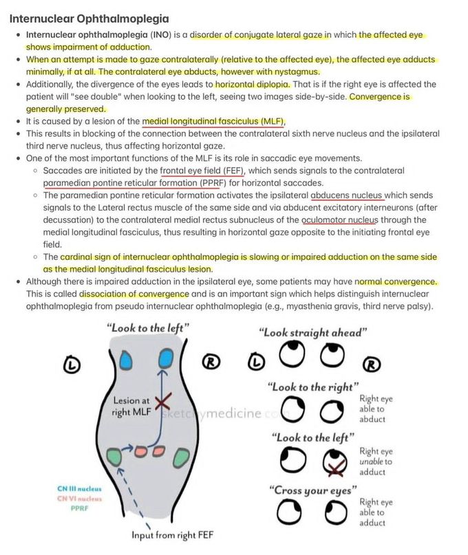 Internuclear Ophthalmoplegia - MEDizzy