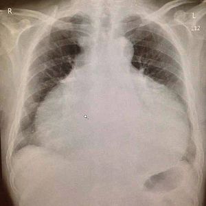 Pericarditis with a massive pericardial effusion - MEDizzy