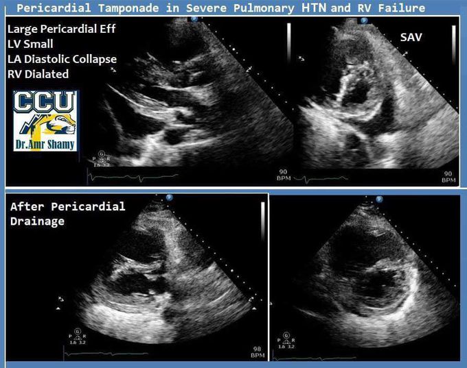 Pericardial Tamponade in Severe Pulmonary Hypertension and - MEDizzy