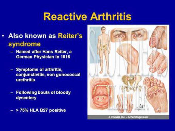 Reactive Arthritis MEDizzy
