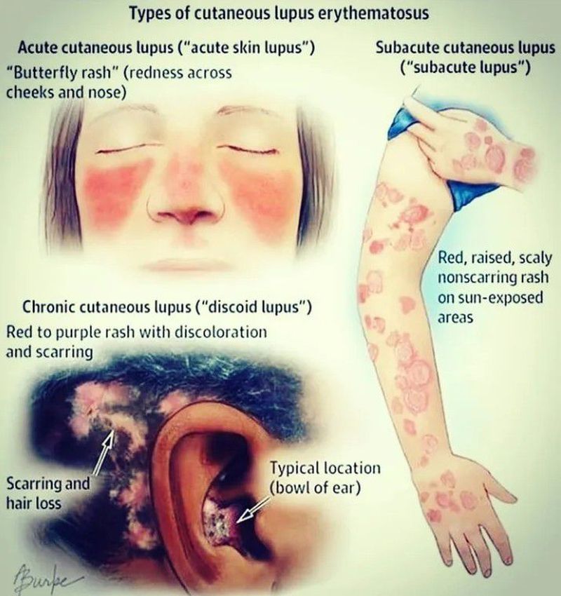 Chronic Cutaneous Lupus Tumid Lupus Erythematosus And Systemic Lupus