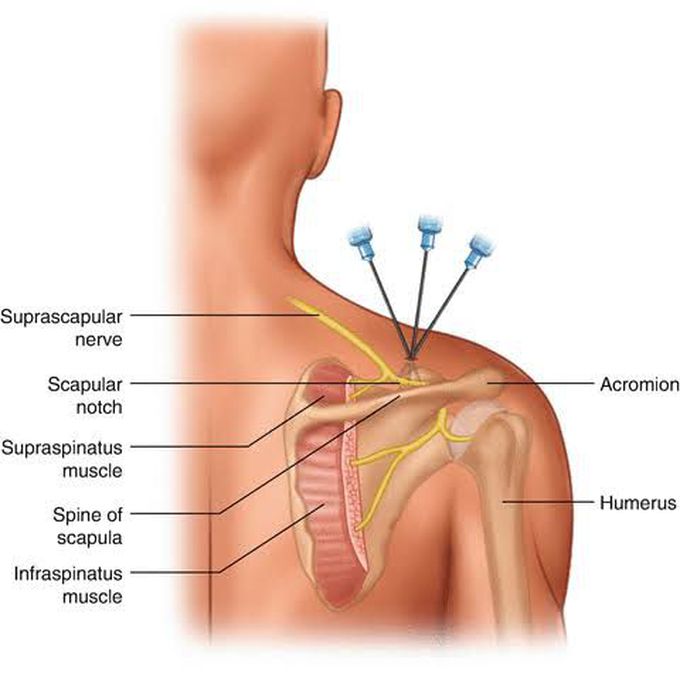 Suprascapular Nerve