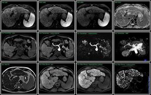 Abdominal Imaging w/Primovist – Cirrhosis @ 1.5T Siemens - MEDizzy