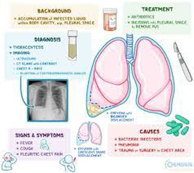 Cause Of Empyema MEDizzy