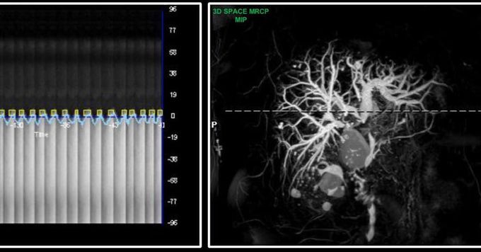 Abdominal Imaging – respiratory triggering @ Siemens 1.5T - MEDizzy